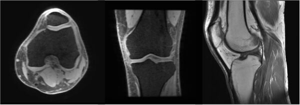 Flex Coils - 1.5T & 3T - NeoCoil
