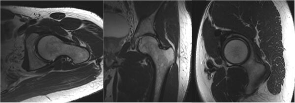 Flex Coils - 1.5T & 3T - NeoCoil