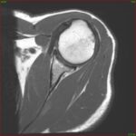 Shoulder Coils - 1.5T & 3T - NeoCoil